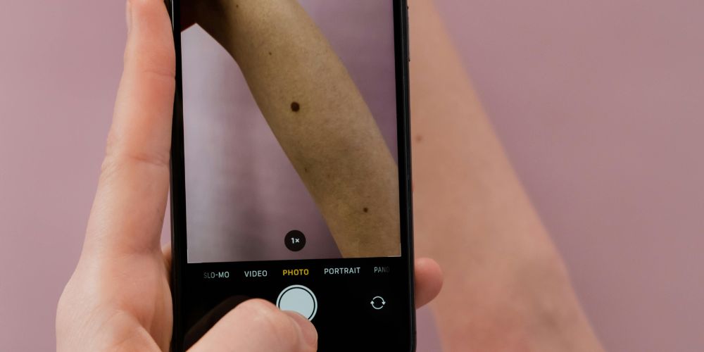 A mole on your forearm makes you part of a special elder millennial club